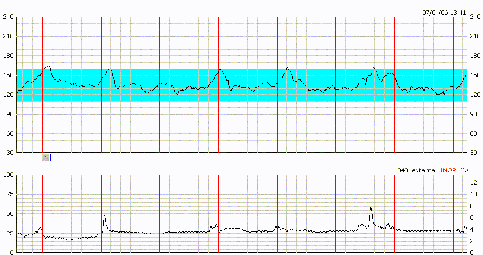 Fetal Tracing Index – Electronic Fetal Monitoring