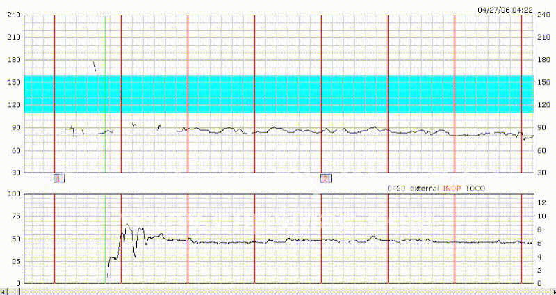 Fetal Tracing Index – Electronic Fetal Monitoring