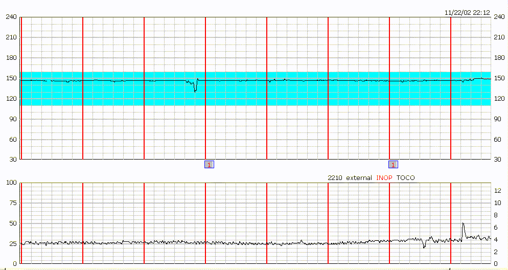 Fetal Tracing Index – Electronic Fetal Monitoring