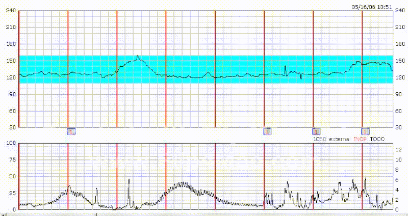 Fetal Tracing Index – Electronic Fetal Monitoring