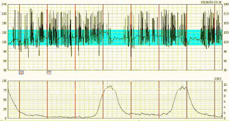 Fetal Tracing Index – Electronic Fetal Monitoring