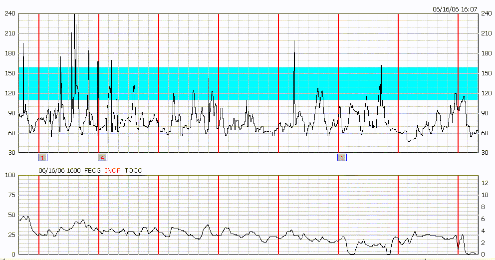 Fetal Tracing Index – Electronic Fetal Monitoring