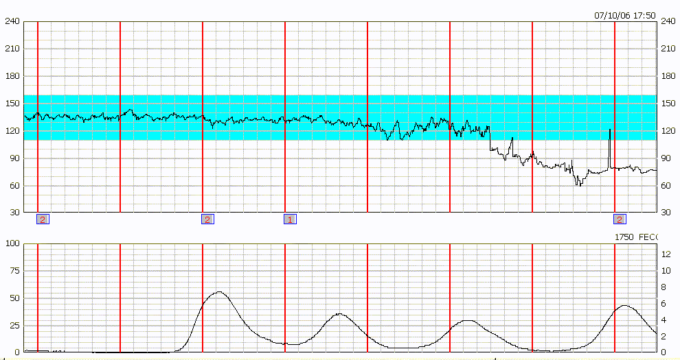 Fetal Tracing Index – Electronic Fetal Monitoring