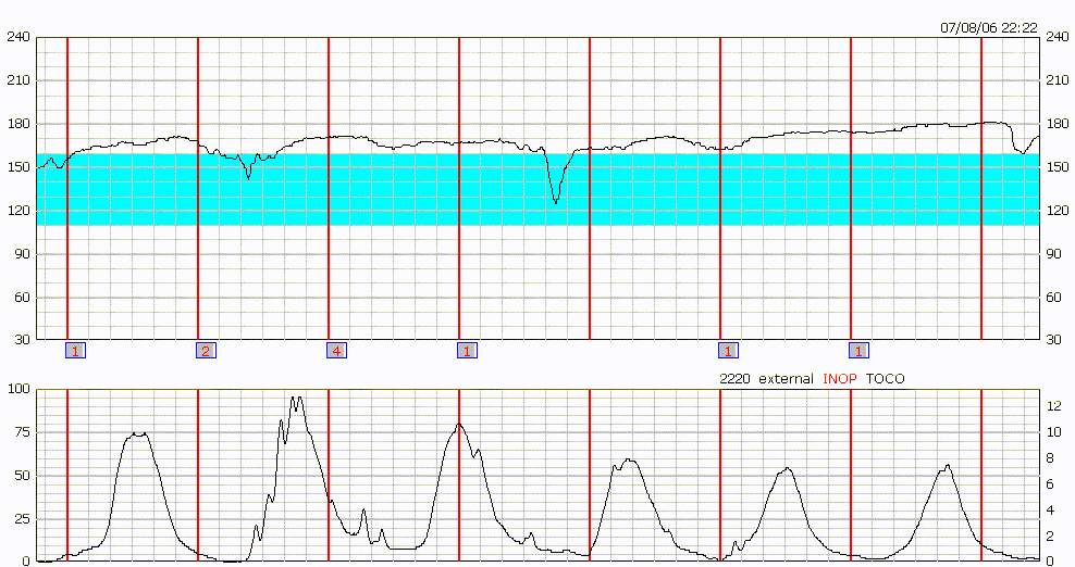 Fetal Tracing Index – Electronic Fetal Monitoring