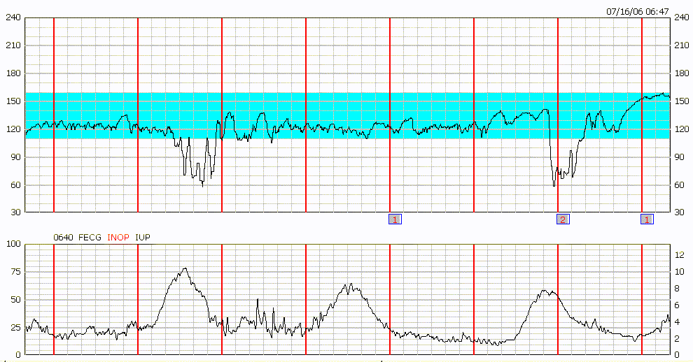 Fetal Tracing Index – Electronic Fetal Monitoring