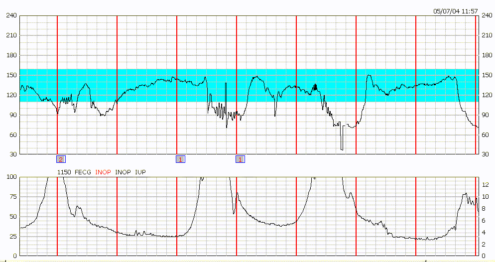 Fetal Tracing Index – Electronic Fetal Monitoring