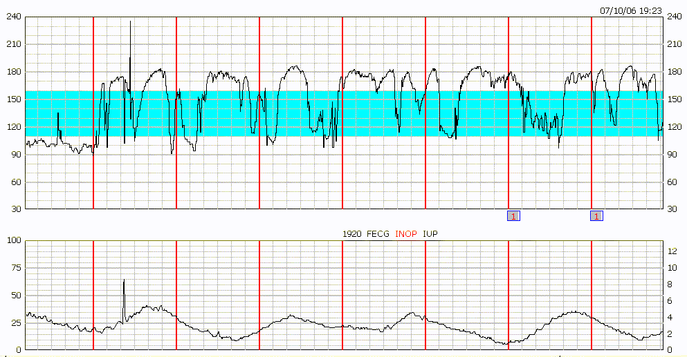 Fetal Tracing Index – Electronic Fetal Monitoring
