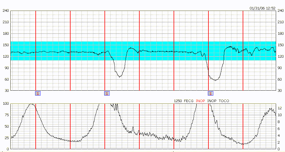 Fetal Tracing Index – Electronic Fetal Monitoring